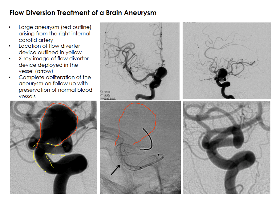Stroke, Neurointervention and Critical Care | Neurology | Medical ...