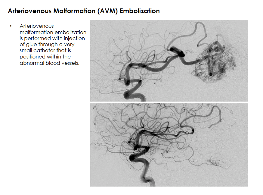 Stroke, Neurointervention and Critical Care | Neurology | Medical ...