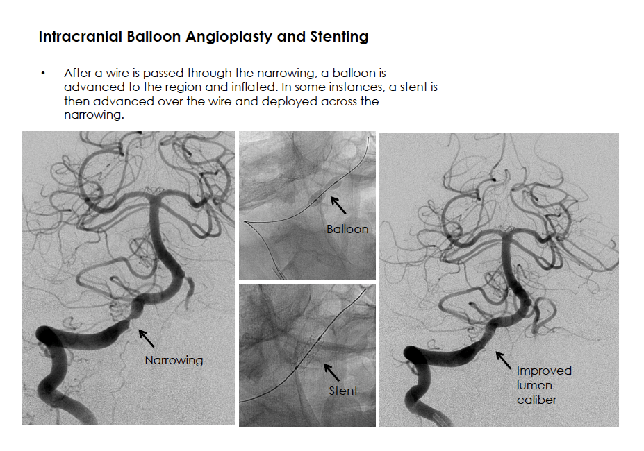 Stroke, Neurointervention and Critical Care | Neurology | Medical ...