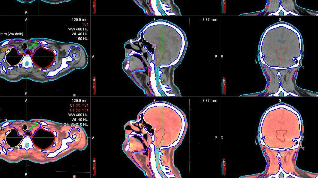 Research | Radiation Oncology | Medical College of Wisconsin
